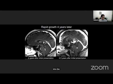 Surgery for deeps seated tumors/Wenya Linda Bi, MD, PhD