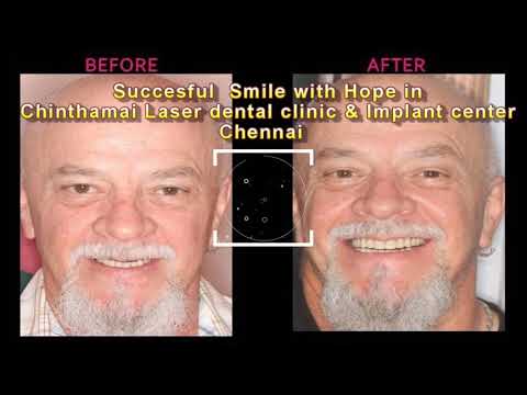 Succesful smile with hope - Chinthamani Laser dental clinic & implant center -Chennai