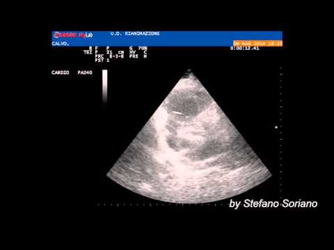 Pulmonary embolism cardiac ultrasound.