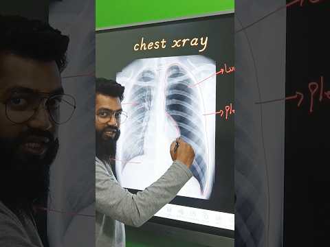Pneumothorax #xray #ct #mri #radiology #medical #viral #anatomy #pathology #doctor #xrayroom #neet