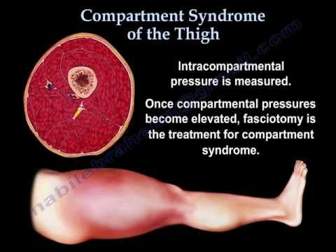 Thigh Compartment Syndrome - Trauma - Orthobullets