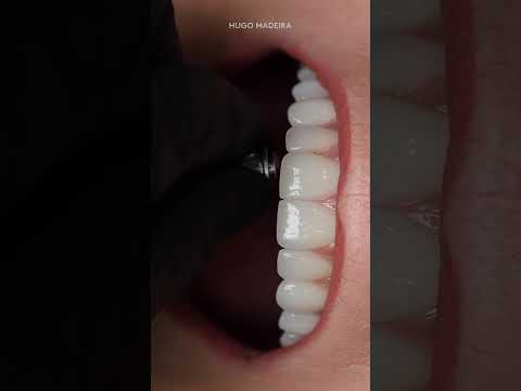 Colocação de duas próteses sobre implantes