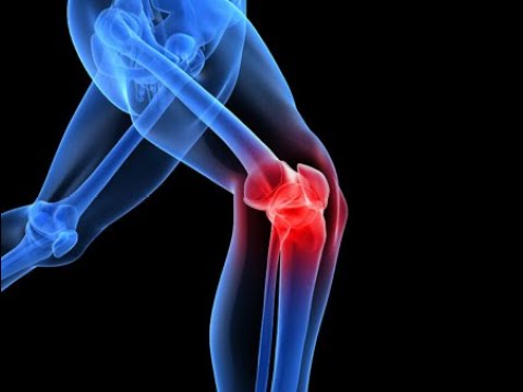 What is Patellofemoral Pain Syndrome?