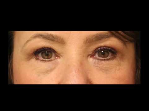 Repairing Ptosis with Blepharoplasty Plastic Surgery