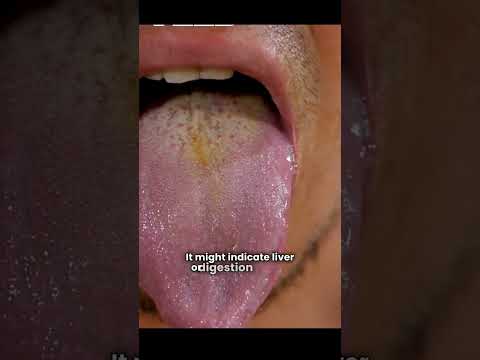 Zaban Ka Rang Kya Batata Hai? | Tongue Colour Health Tips