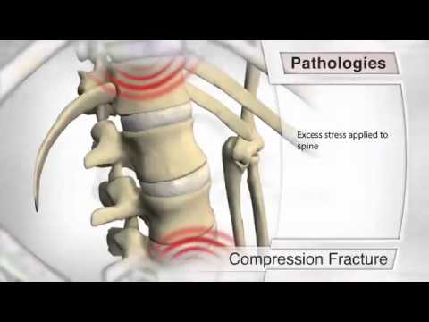 Compression Fracture Pathology