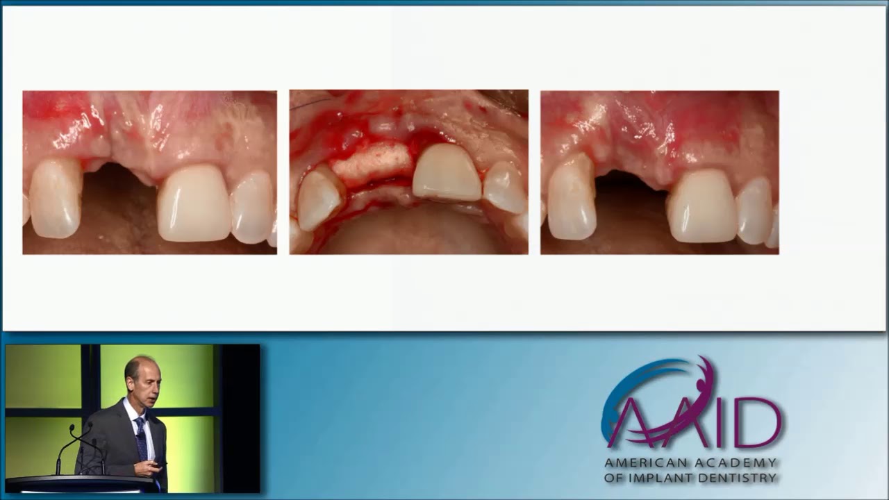The Impact of a Comprehensive Digital Workflow on Single-Tooth Implant Therapy