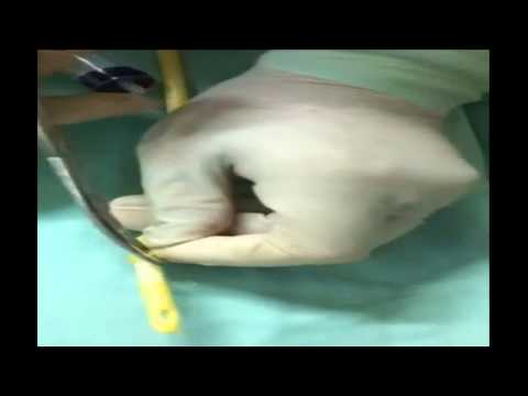 How to use a standard Foley-catheter for Bladder washing, if a 3-ways catheter is not available