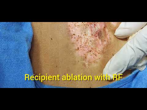 Non cultured melanocyte transplant (NCMT) | VITILIGO SURGERY| STABLE VITILIGO