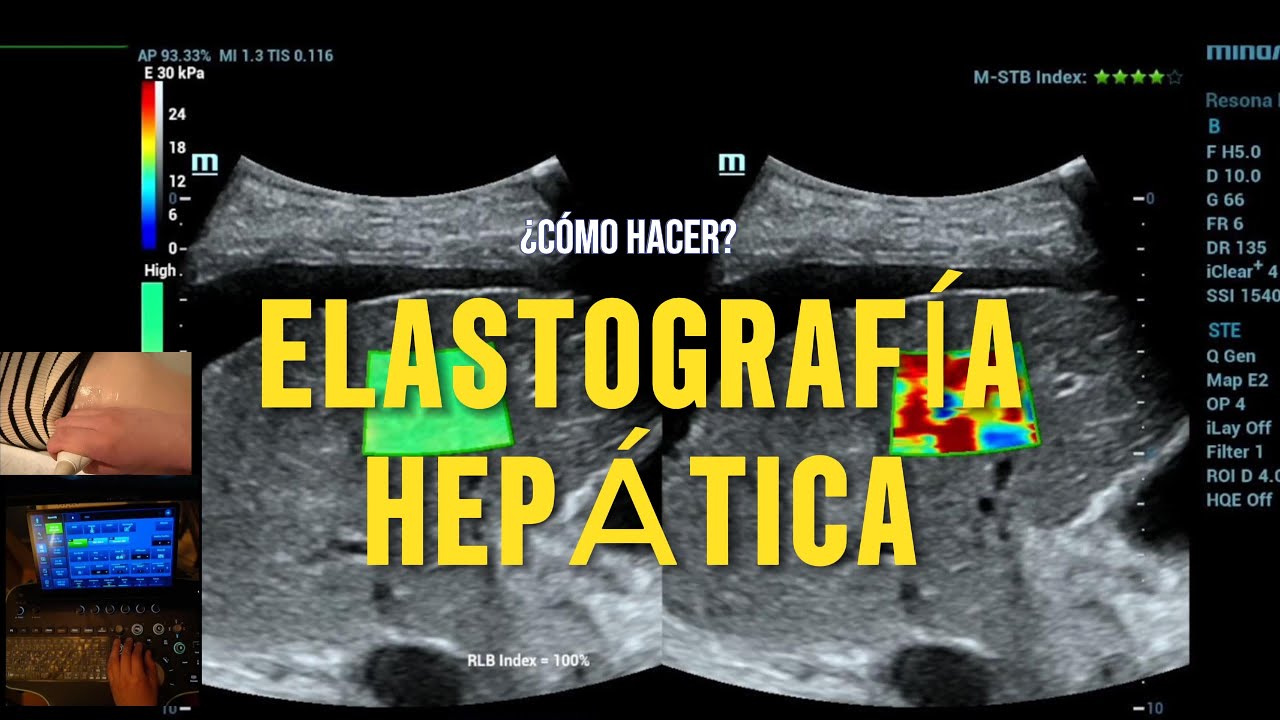 TUTORIAL: ELASTOGRAFÍA HEPÁTICA POR ULTRASONIDO STE