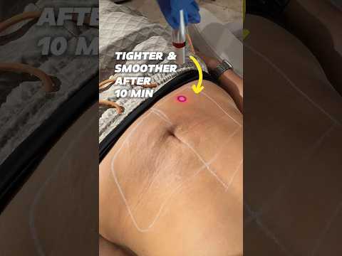 Laser Photobiomodulation Therapy to Tighten Your Skin in Minutes 🤩