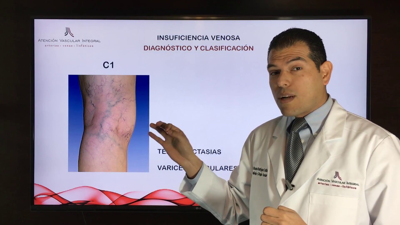 5  Insuficiencia Venosa  Diagnóstico y Clasificación