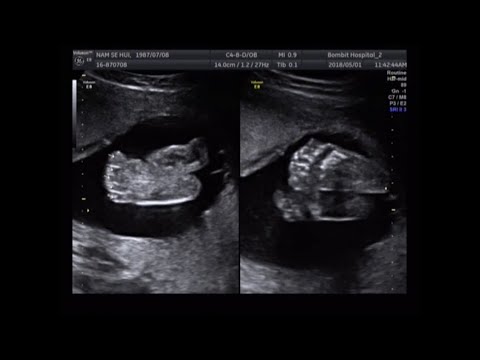 fetal ultrasound of 20 weeks 21 weeks baby boy moving