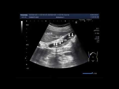 Video showing differentiation between polyps, stones, Sand particles and sludge in Gall Bladder.
