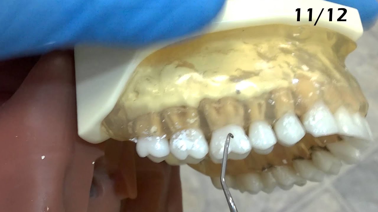 Gracey's- 3 Ways to Determine the Correct Working End