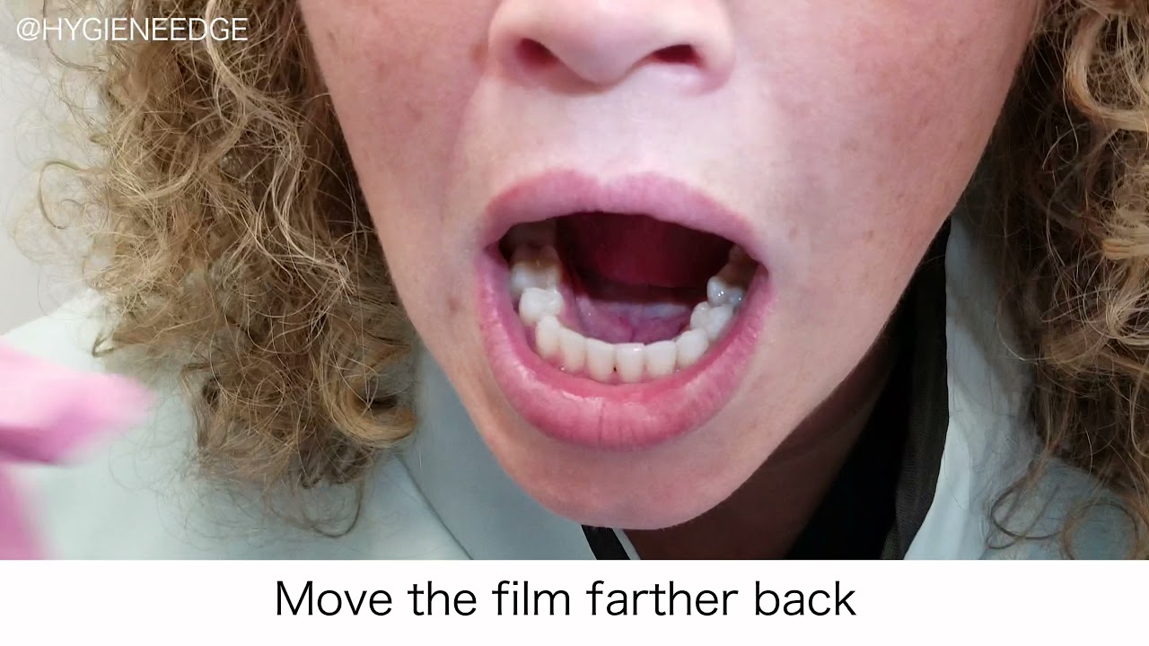 Tricky Tori? Tips for Anterior PA's.