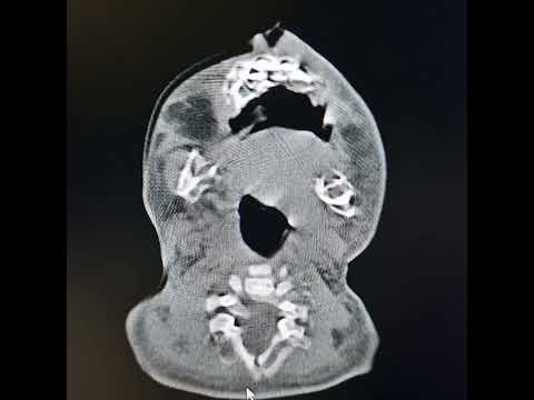 Occipitocervical meningocele+ Dandy walkar malformation.