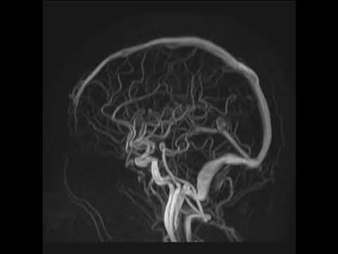 CNS C2 MR Venogram