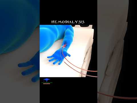 Artificial Kidney (Hemodialysis) Animated video ' #shorts
