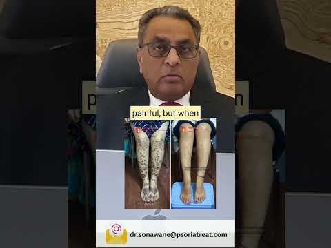 What is lichen planus