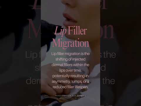Filler Gone Wrong? How to Spot Lip Migration"