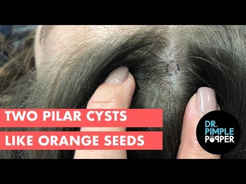 Dr. Pimple Popper Extracts Pilar Cysts Like Orange Seeds in New Video