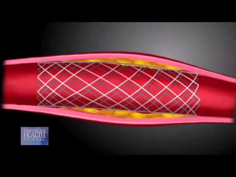 What are Stents - Narasimha Rao, MD