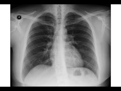 Chest x-ray - Pulmonary Fibrosis on HRCT
