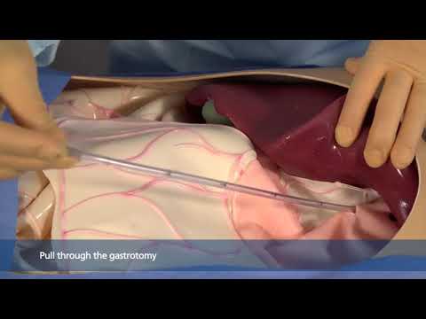 EEA™ OrVil™ Transoral Circular Stapler In Service Video