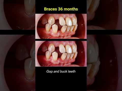 Braces as magic :) #braces #orthodontist #dentist