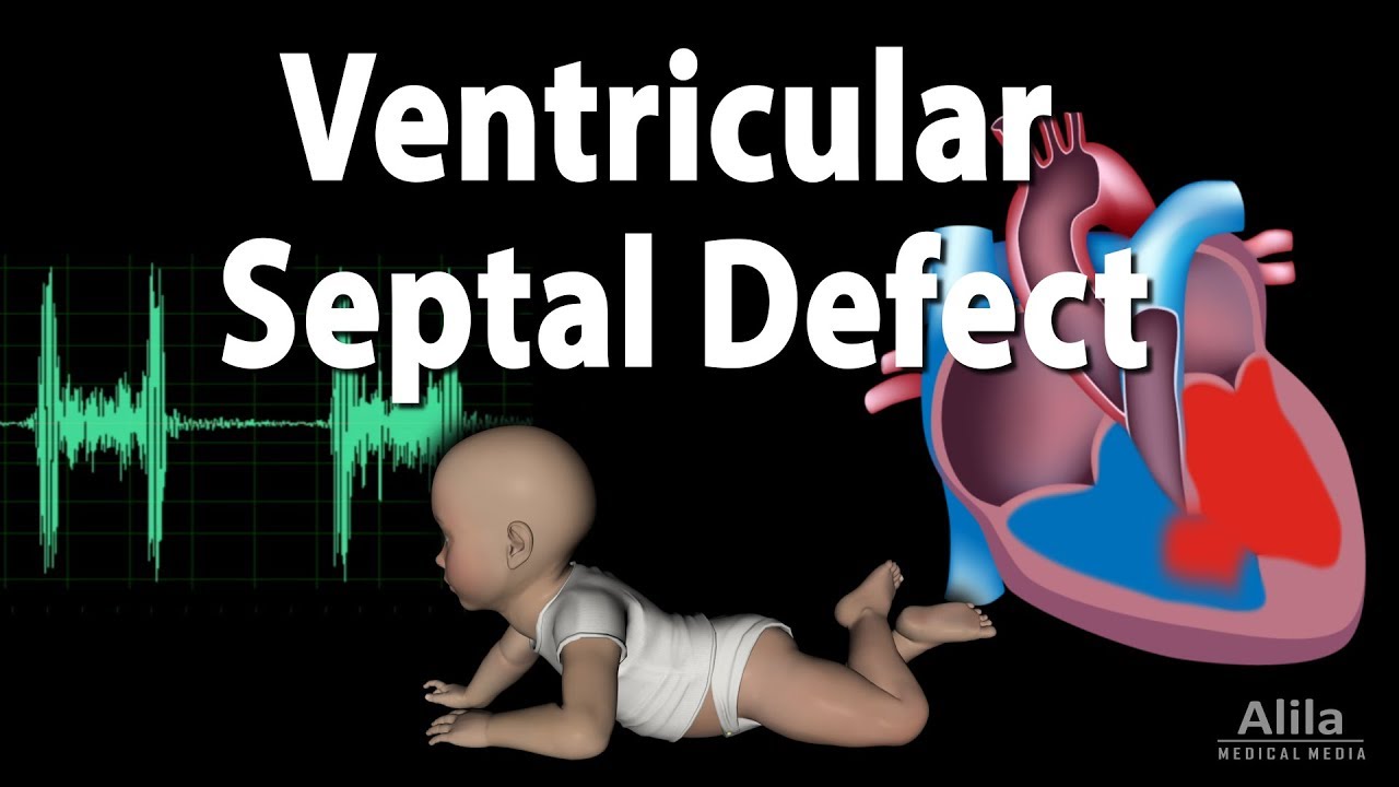 Ventricular Septal Defect, Animation
