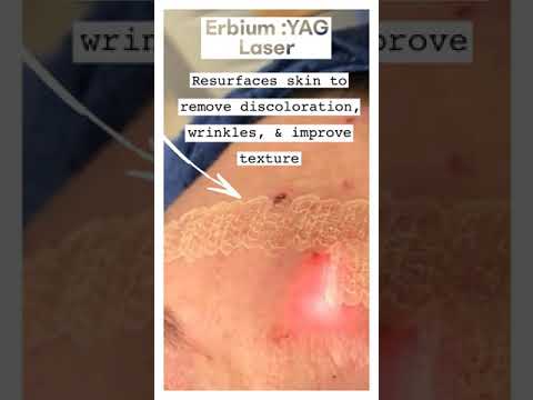 Erbium: YAG laser skin resurfacing