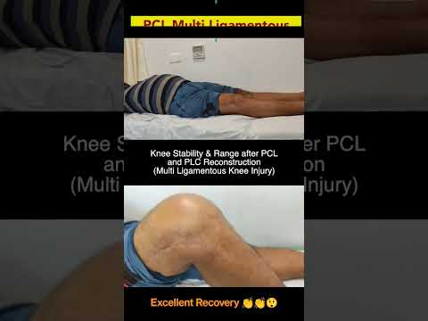 Excellent Recovery after PCL & PLC Reconstruction - Dr Jitesh Jain #acltear #aclrehab #pcltear