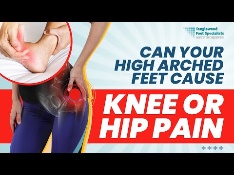Can Your High Arched Feet Cause Knee or Hip Pain?