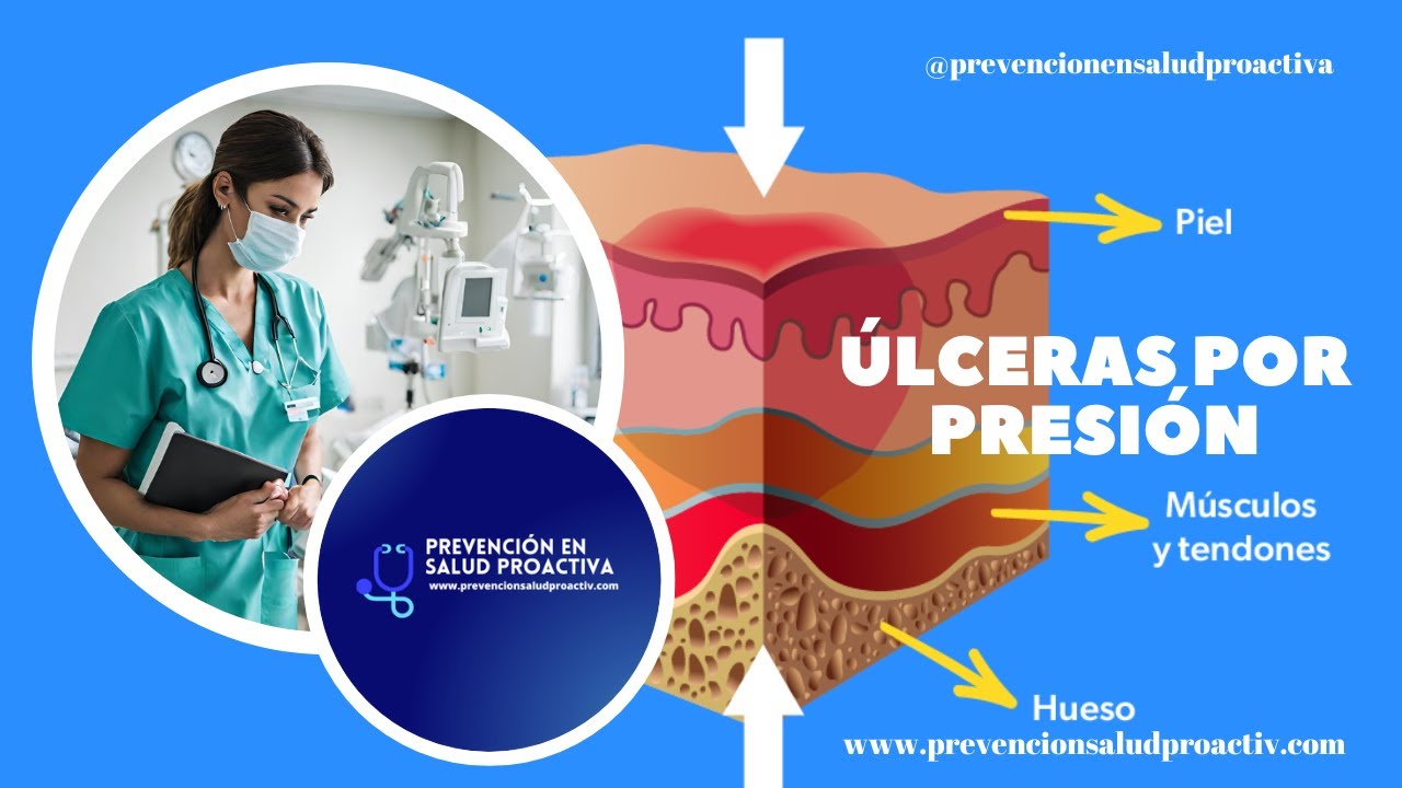 ✅ 🧴ÚLCERAS POR PRESIÓN en Enfermería👩🏻‍⚕️