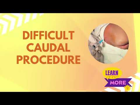 A difficult caudal: anatomical land marks explained - Dr Kapila Hettiarachchi, lead consultant SBSCH