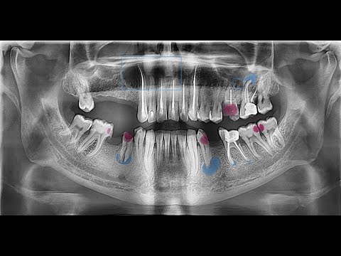 AI using second opinion from Pearl on a panoramic radiograph (Arabic tutorial)
