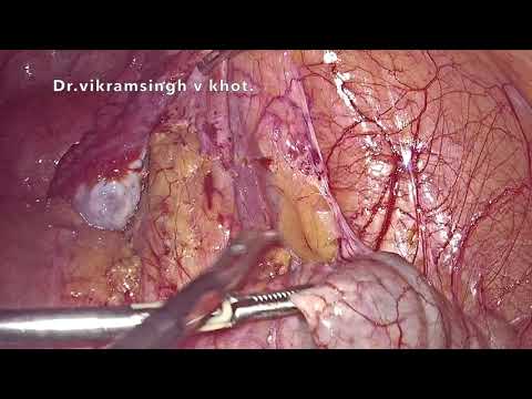 chronic pain in RIF