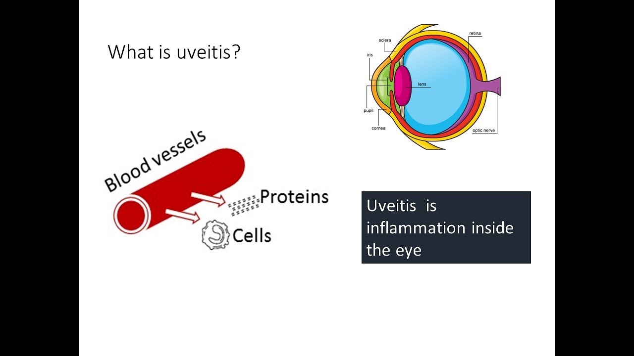 Childhood Uveitis