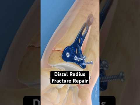 Mending a broken wrist with plate and screws (3D Animation)