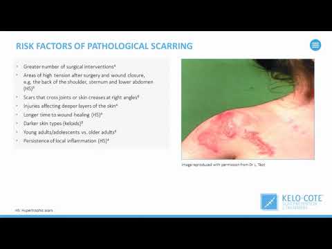 Latest thinking in scar prevention and treatment A guide to managing and treating scars