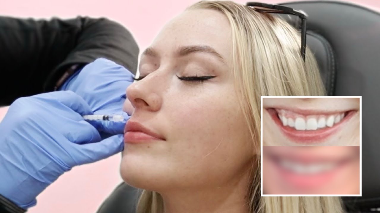 Getting a Botox Lip Flip - Worth it?