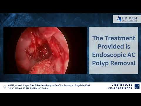 Antrochoanal Polyp Removal