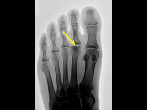 Understand Freiberg's Disease in 5 minutes
