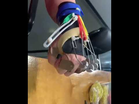 Dynamic and Static Custom Splinting