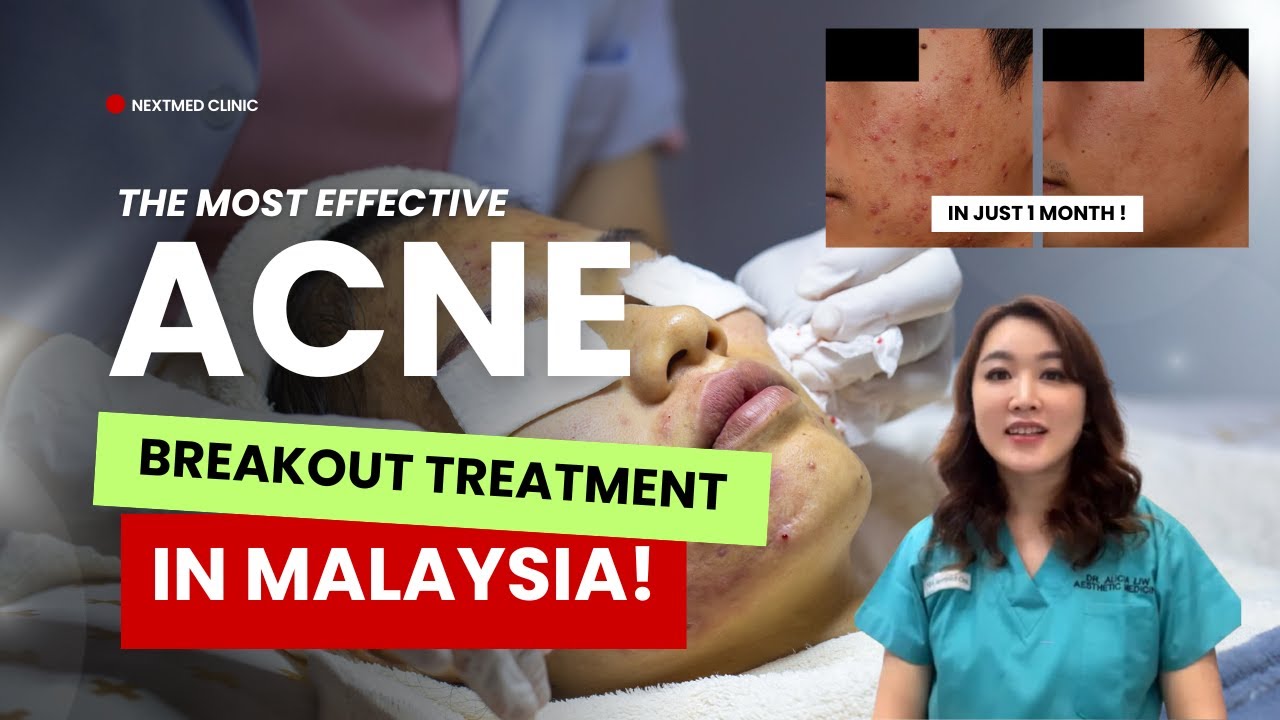 Effective Acne Breakout Treatment in Malaysia | Affordable Solutions for Clear Skin