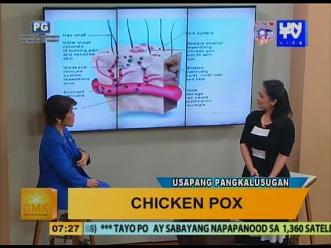 Good Morning Kuya: Chicken Pox - Symptoms and Treatment