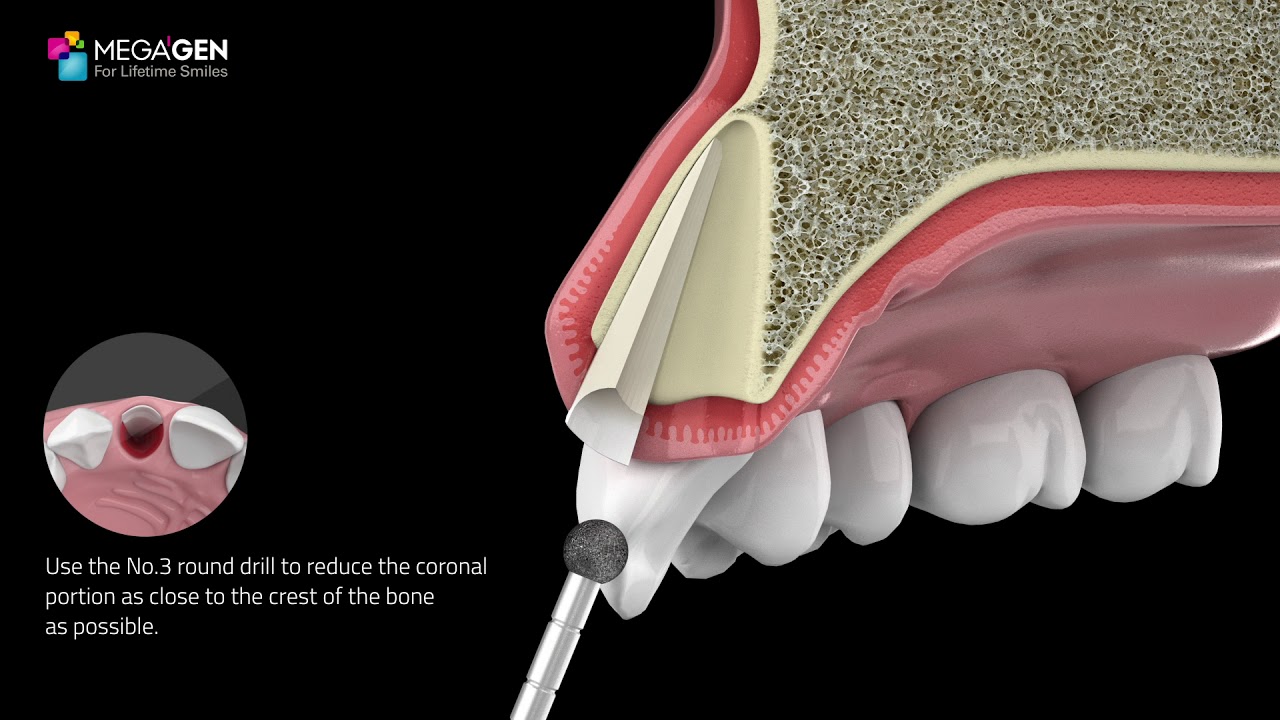 MegaGen PET Kit - Partial Extraction Therapy