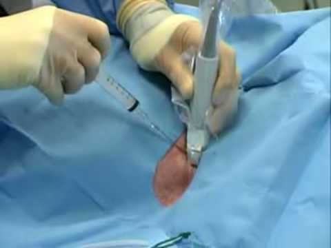 Internal Jugular Cannulation | DoctorsTube