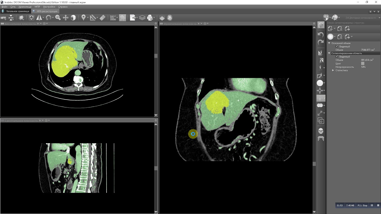 Segmentation using EDT based region growing
